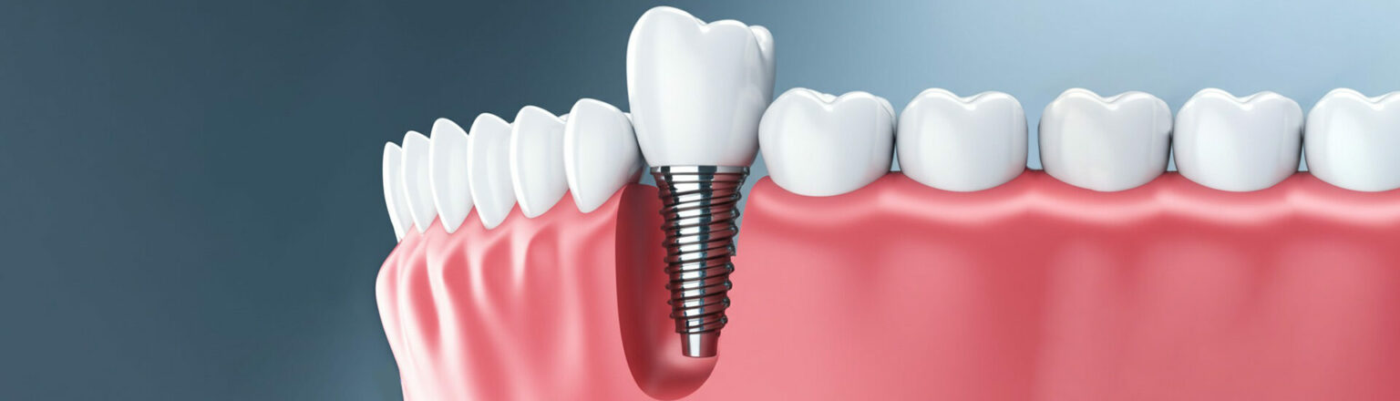 Should There Be a Gap Between Gum and Implant? What You Need to Know ...